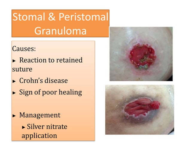 Stoma complications by Prof. Ajay Khanna, IMS, BHU, Varanasi India | PPTX