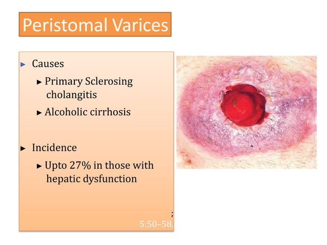 Stoma complications by Prof. Ajay Khanna, IMS, BHU, Varanasi India | PPTX