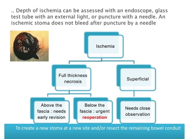 Stoma complications by Prof. Ajay Khanna, IMS, BHU, Varanasi India | PPTX