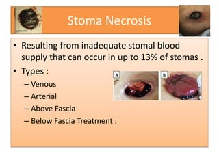 Stoma complications by Prof. Ajay Khanna, IMS, BHU, Varanasi India | PPT
