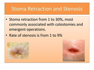 Stoma complications by Prof. Ajay Khanna, IMS, BHU, Varanasi India | PPT