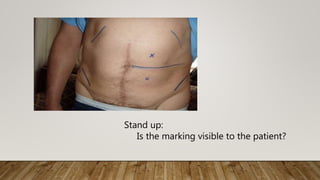 Stoma indication | PPTX