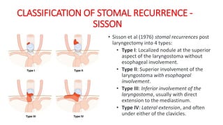 STOMAL RECURRENCE AFTER LARYNGECTOMY-1.pptx