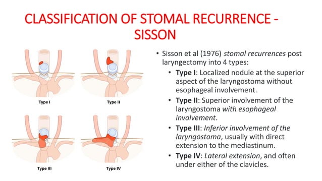STOMAL RECURRENCE AFTER LARYNGECTOMY-1.pptx | Ear, Nose and Throat ...