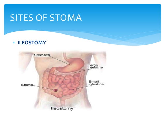 Stomal therapy | PPTX