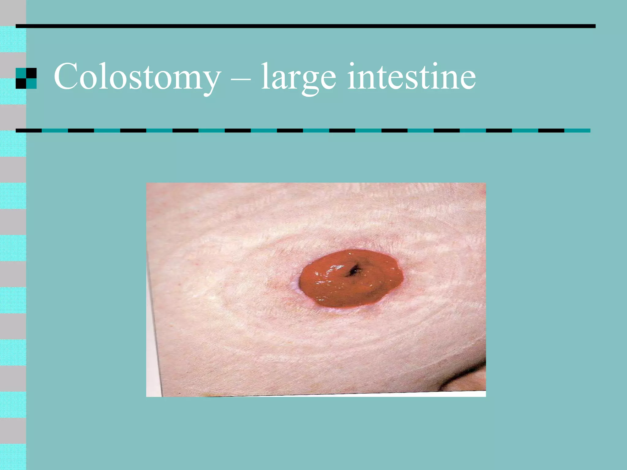 Stoma modules caring for the stoma patient | PPT