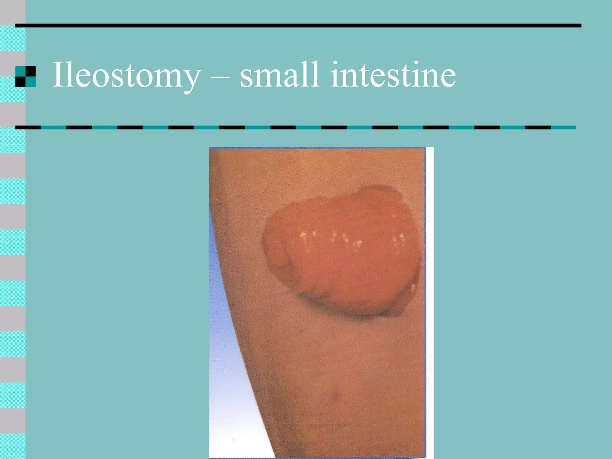 Stoma modules caring for the stoma patient | PPT