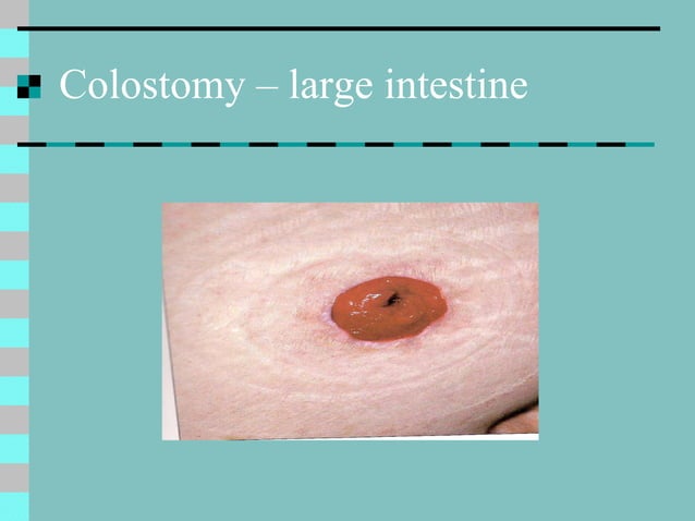 Stoma modules caring for the stoma patient | PPT