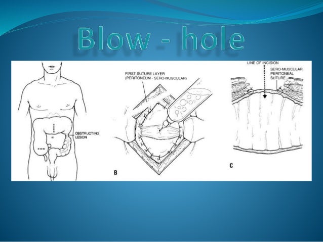 Stomas- Dr.Enja Amarnath Reddy