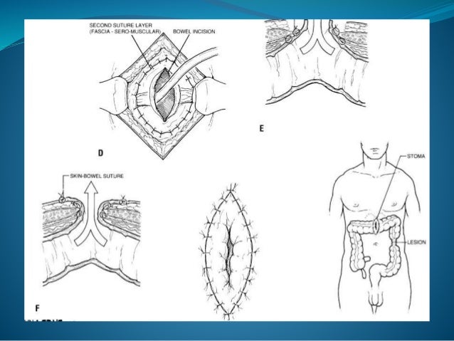 Stomas- Dr.Enja Amarnath Reddy