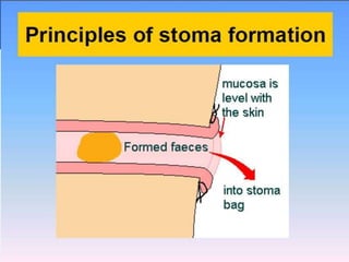 Stomas | PPTX
