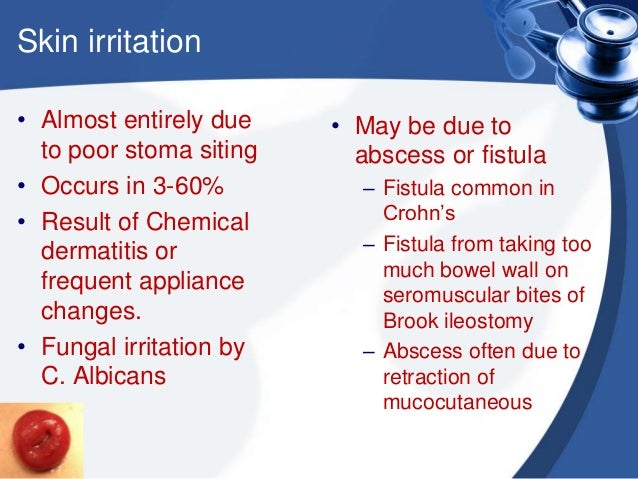 Stoma Common Problems