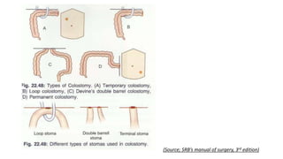 Stoma | PPT