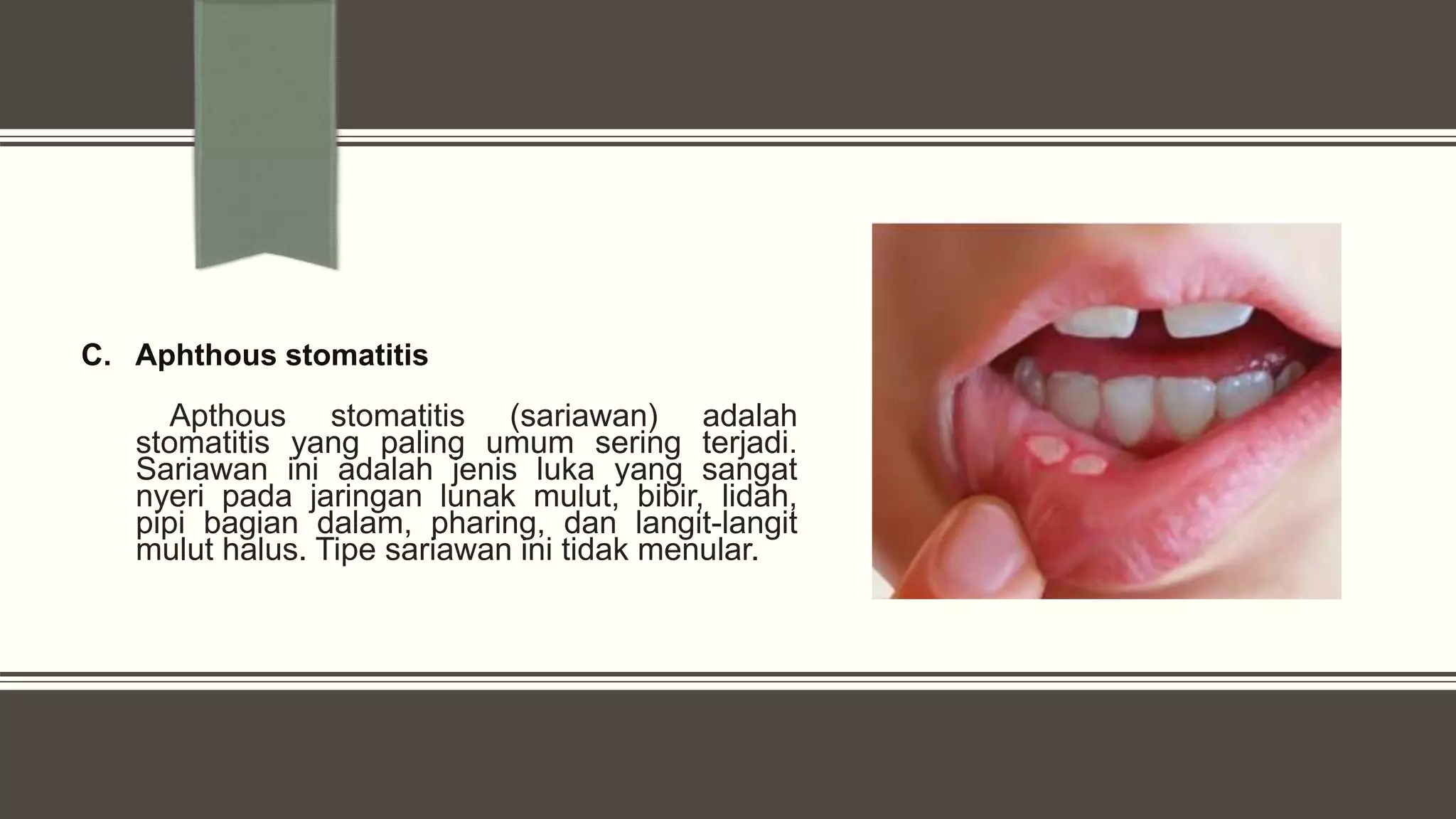Stomatitis | PPTX
