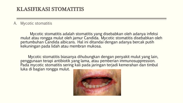 Stomatitis | PPTX