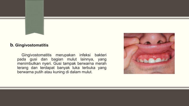 Stomatitis | PPTX