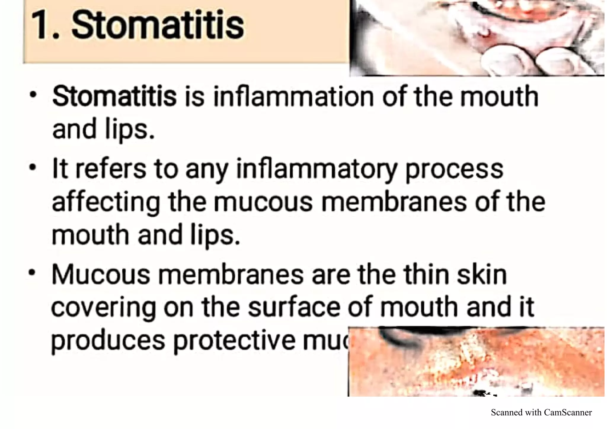stomatitis | PDF