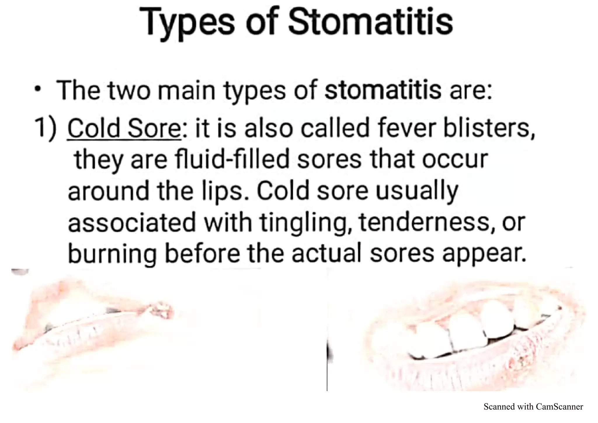 stomatitis | PDF