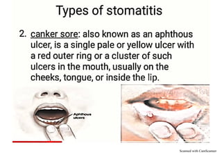 stomatitis | PDF