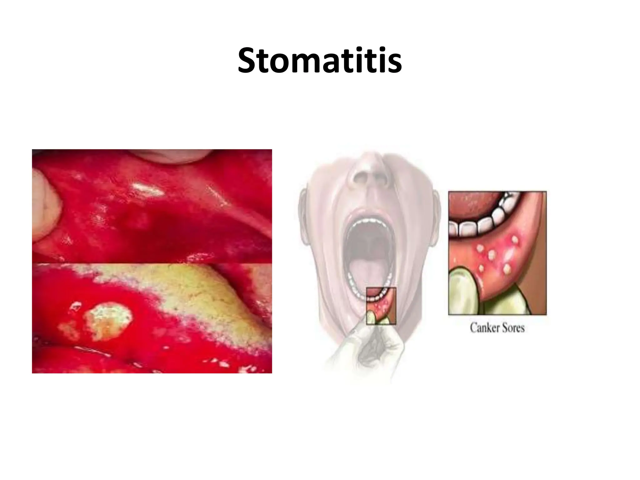INFECTION OF THE ORAL MUCOSA AFFECTING INGESTION | PDF