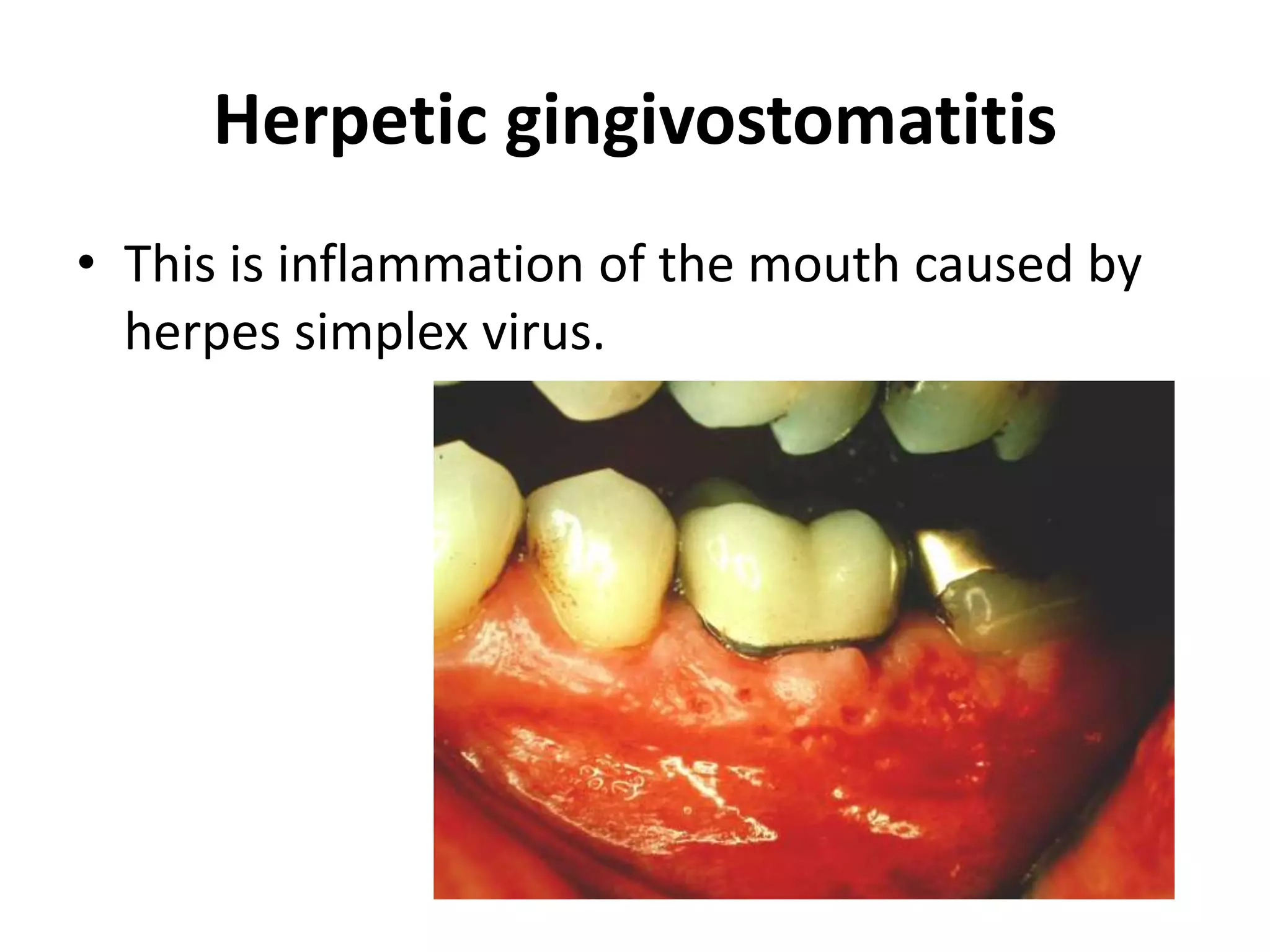 Stomatitis (AHN) | PPTX