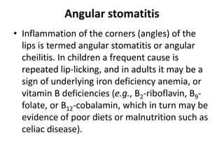 Stomatitis (AHN) | PPTX