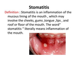 Stomatitis (AHN) | PPTX