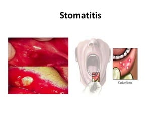 Stomatitis (AHN) | PPTX