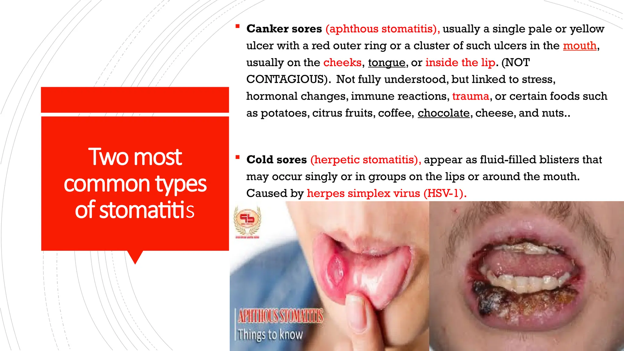 Complete Guide to Stomatitis: Causes, Symptoms, Treatment and ...