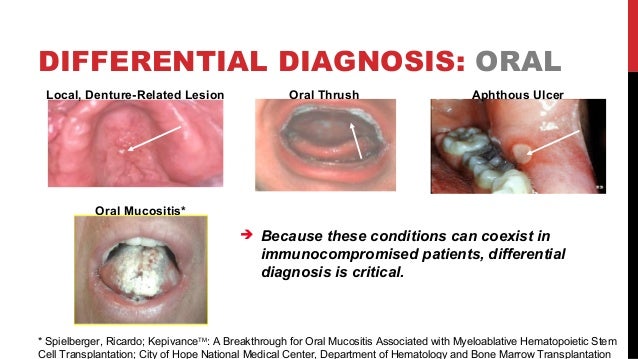Stomatitis in oncology
