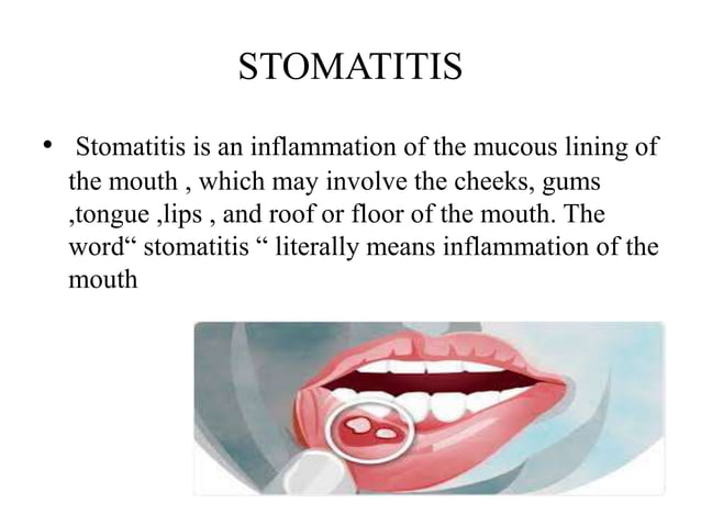 stomatits.pptx | Dental Health | Diseases and Conditions