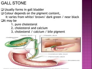 stone analysis renal,gall stone, ureteric stones.pptx