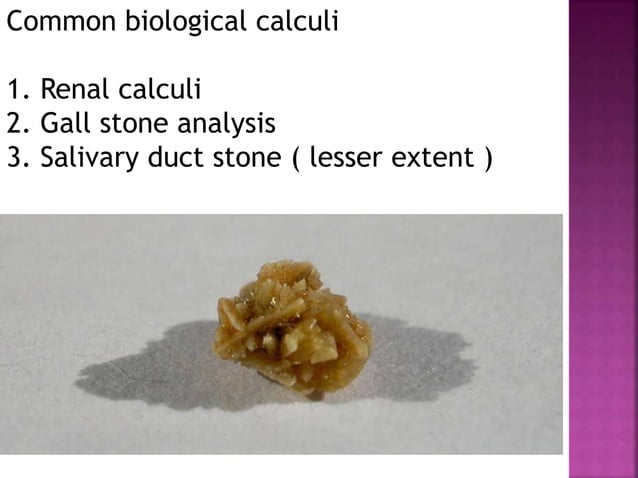 stone analysis renal,gall stone, ureteric stones.pptx | Chemistry | Science