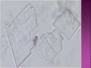stone analysis renal,gall stone, ureteric stones.pptx