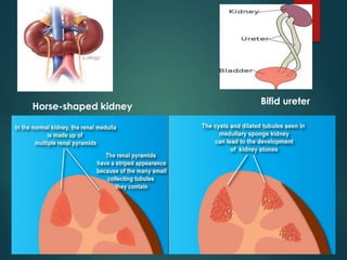 Urinary Stone analysis | PPTX