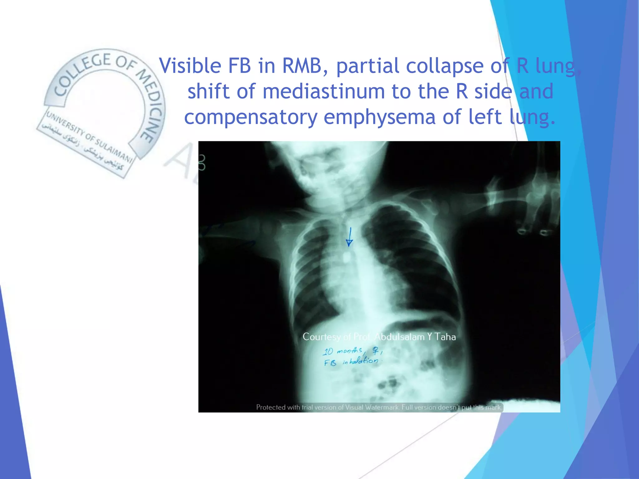 Stone in Right Main Stem Bronchus.pdf