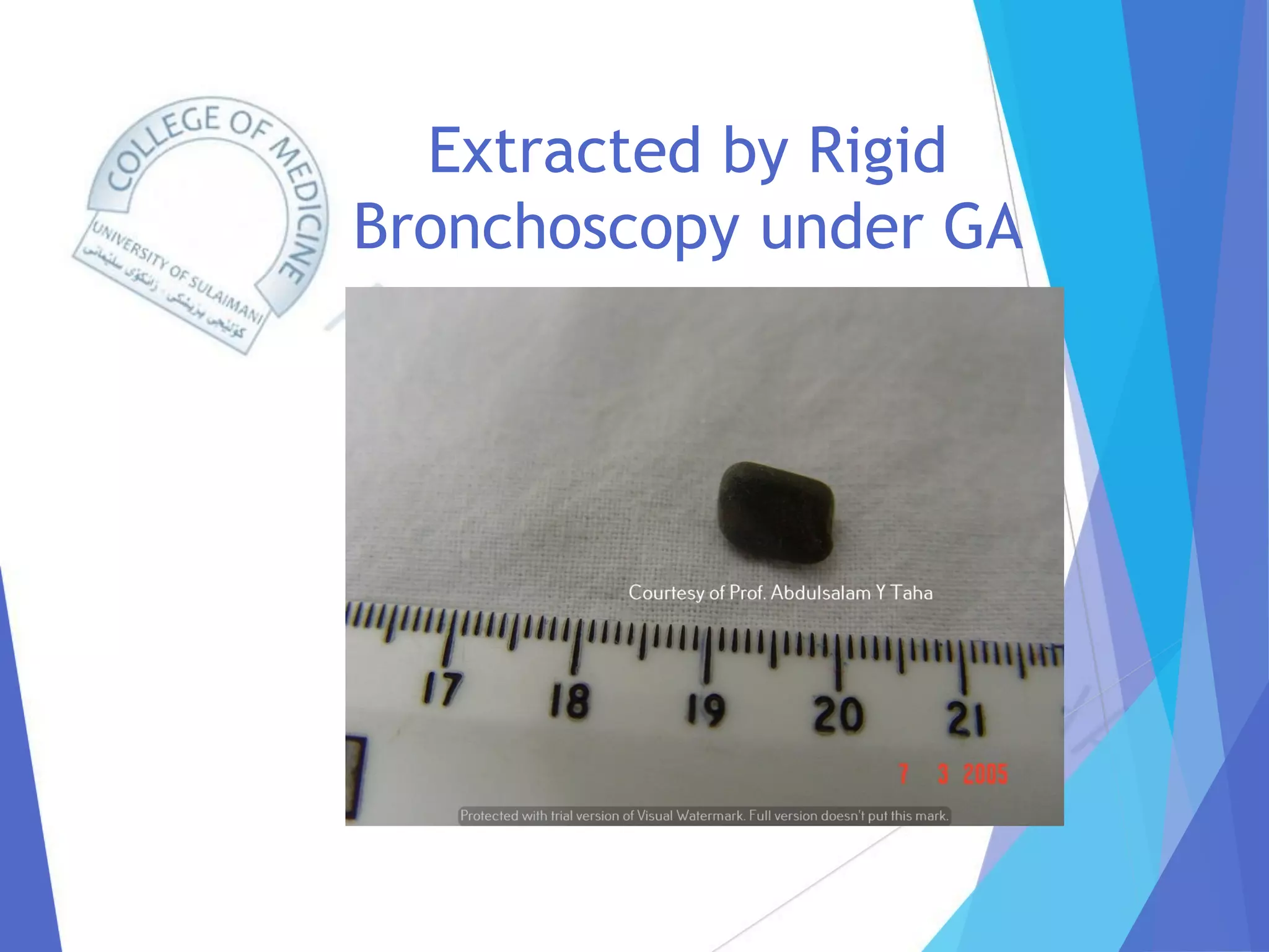 Stone in Right Main Stem Bronchus.pdf