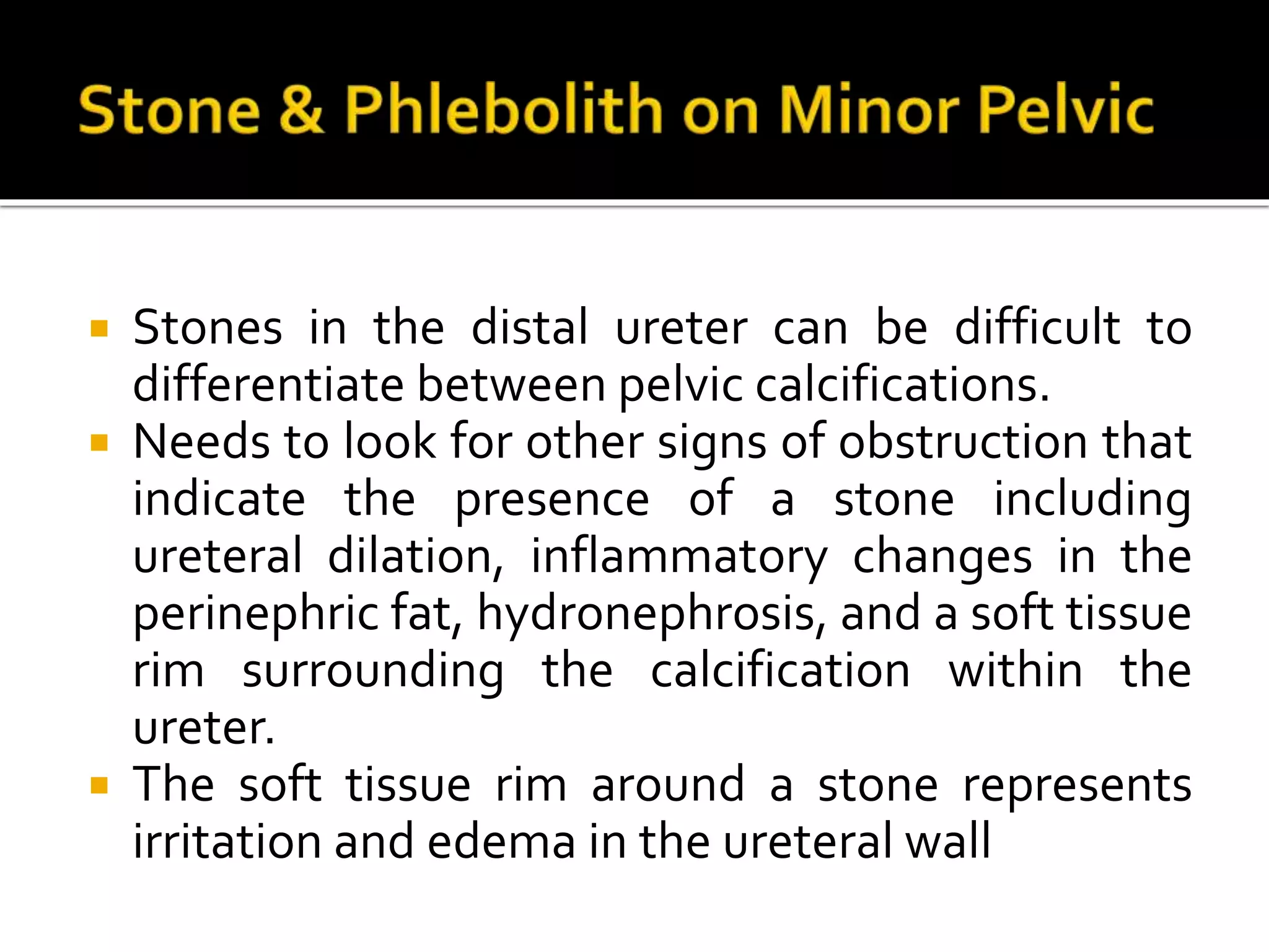Stone & Phlebolith | PPTX