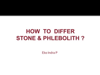 Stone & Phlebolith | PPT