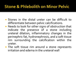 Stone & Phlebolith | PPT