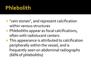 Stone & Phlebolith | PPT