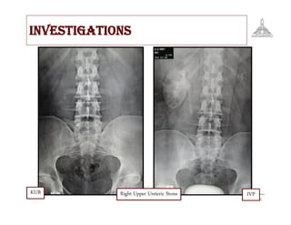 Stones & instrumentation | PPT