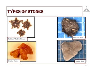 Stones & instrumentation | PDF