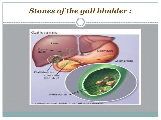 Stones of the gall bladder