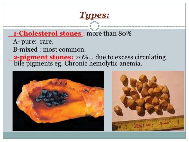 Different Types Of Gall Stones