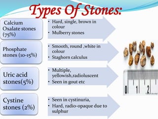 Stones & tumours of kidney ppt.- by Smriti singh | PPT