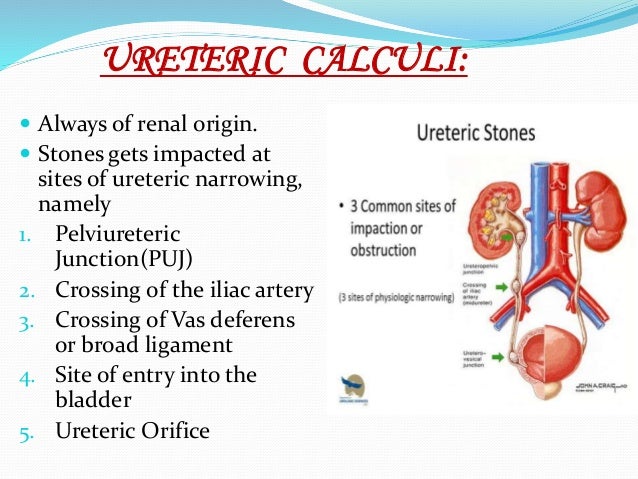 Stones & tumours of kidney ppt.- by Smriti singh