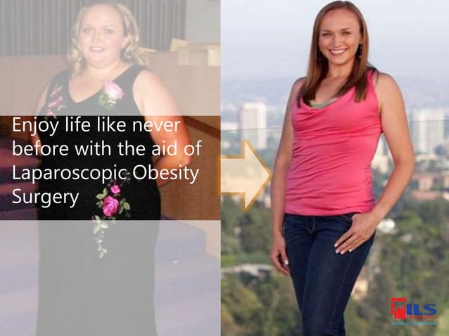 Stop being called as "Fat" - Choose Laparoscopic Obesity Surgery to ...