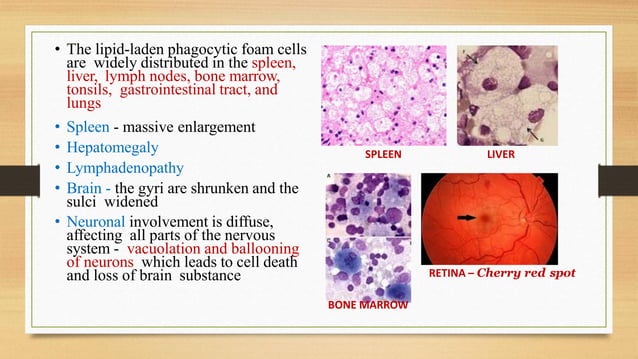 Lysosomal Storage Disorder gaucher and niemann.pdf