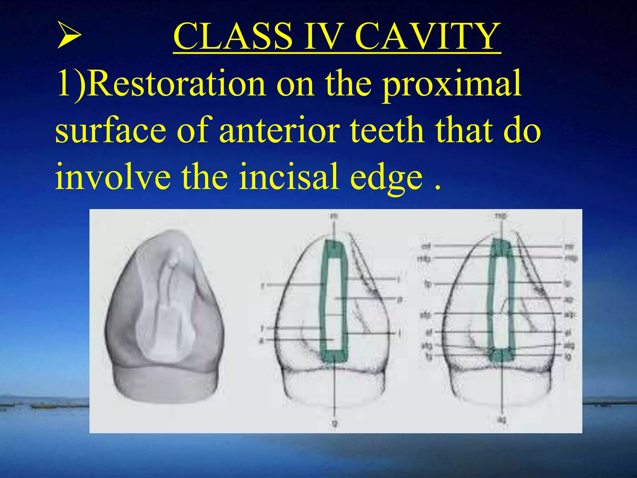 Principles of cavity preparation by Dr .rupali | PPT